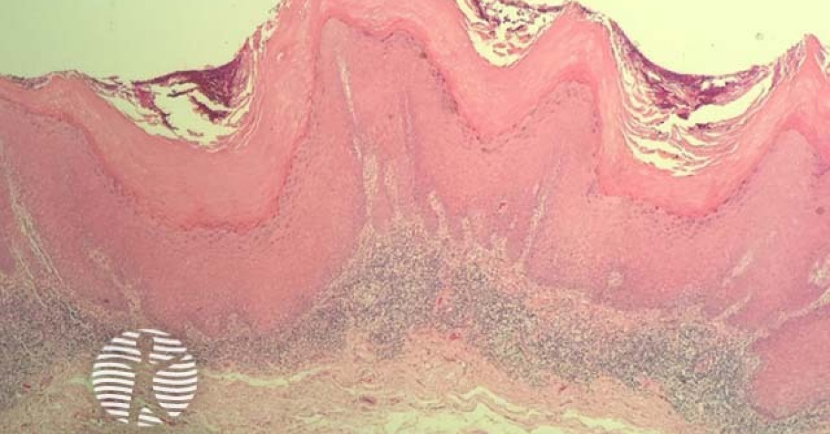 Pseudoepitheliomatous keratotic and micaceous balanitis image