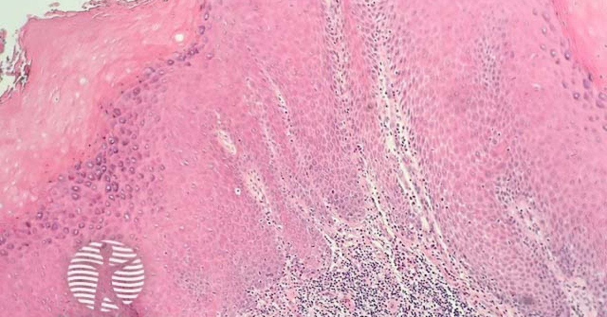 Pseudoepitheliomatous keratotic and micaceous balanitis image