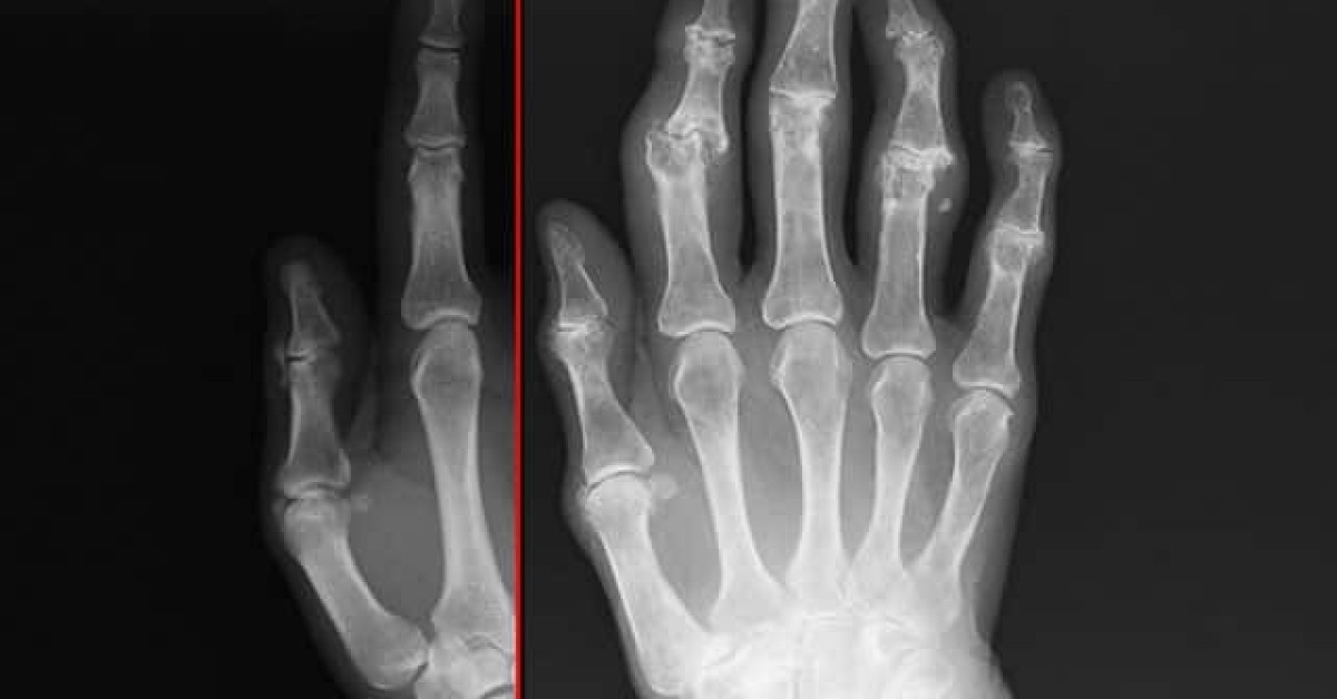 X-ray of Heberden and Bouchard nodes image