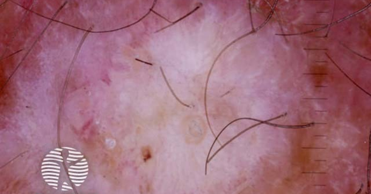 Squamous cell carcinoma, keratoacanthoma type, polarised dermoscopy ...