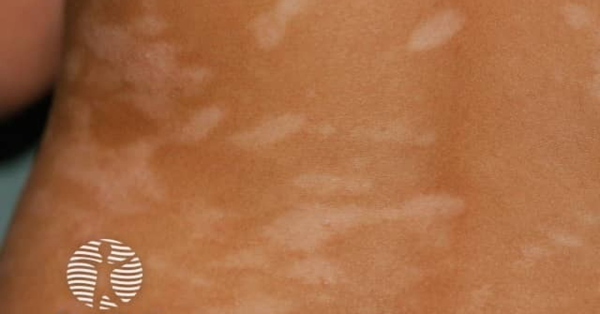 Atopic dermatitis postinflammatory hypopigmentation image