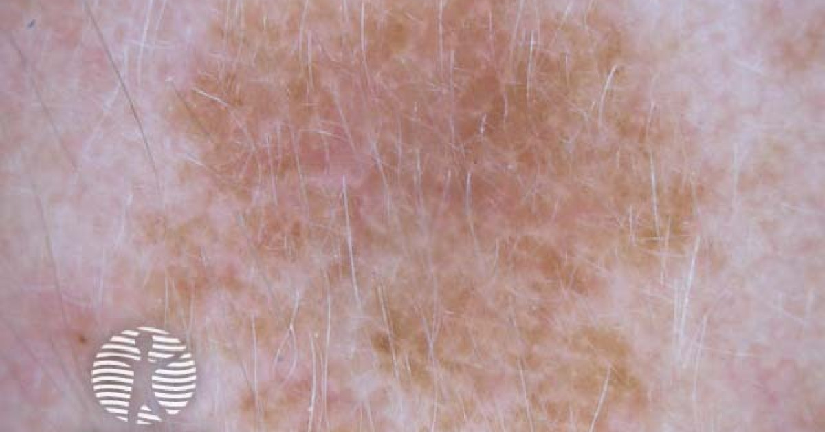 Solar lentigo dermoscopy image