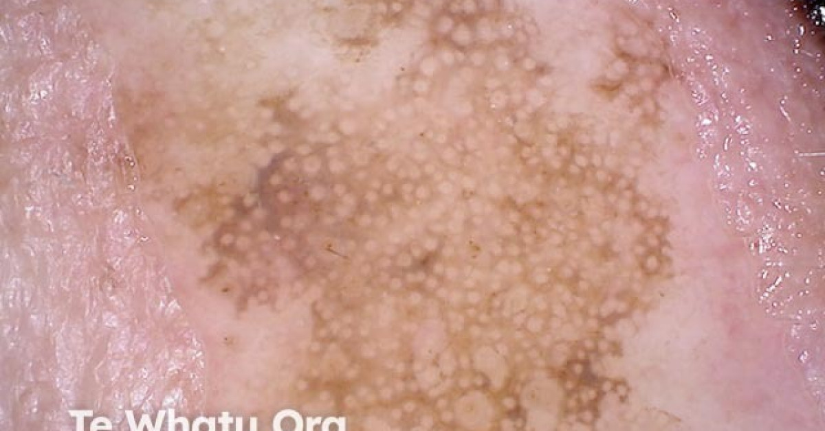 Dermoscopy of solar lentigo image