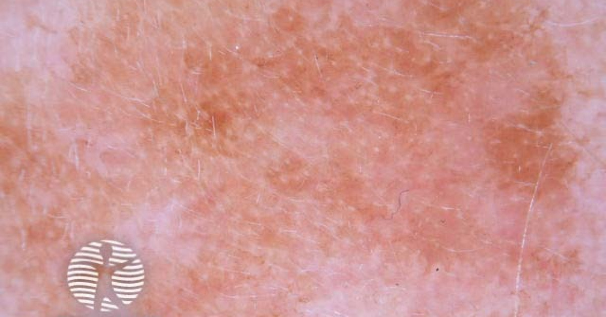 Solar lentigo dermoscopy image