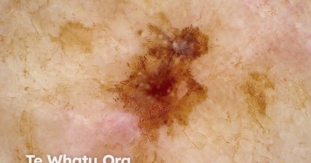 Solar lentigo dermoscopy image