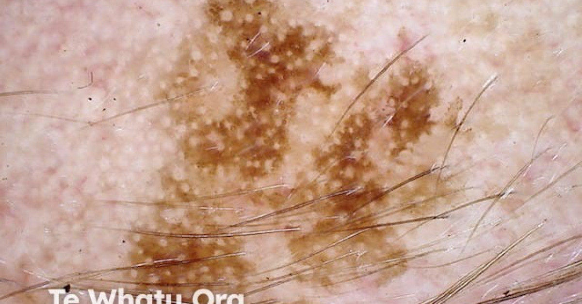 Solar lentigo dermoscopy image