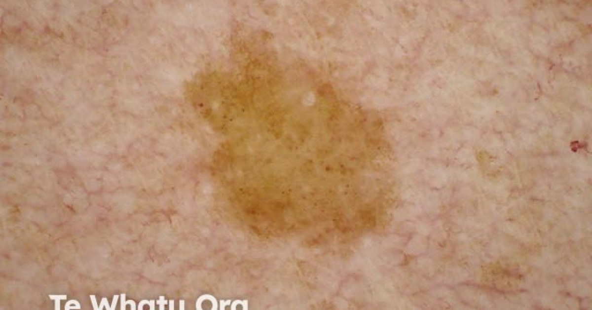 Solar lentigo dermoscopy image