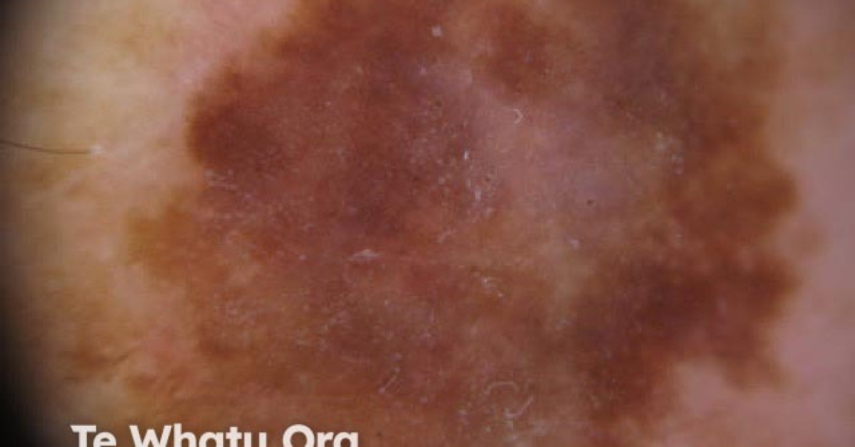 Solar lentigo dermoscopy image