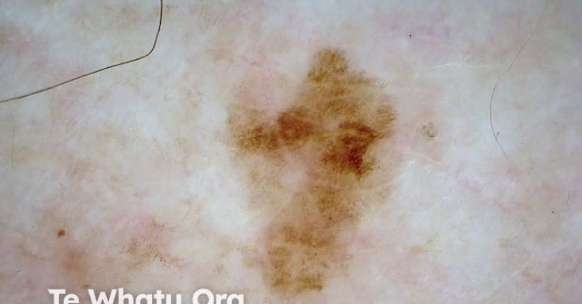 Solar lentigo dermoscopy image