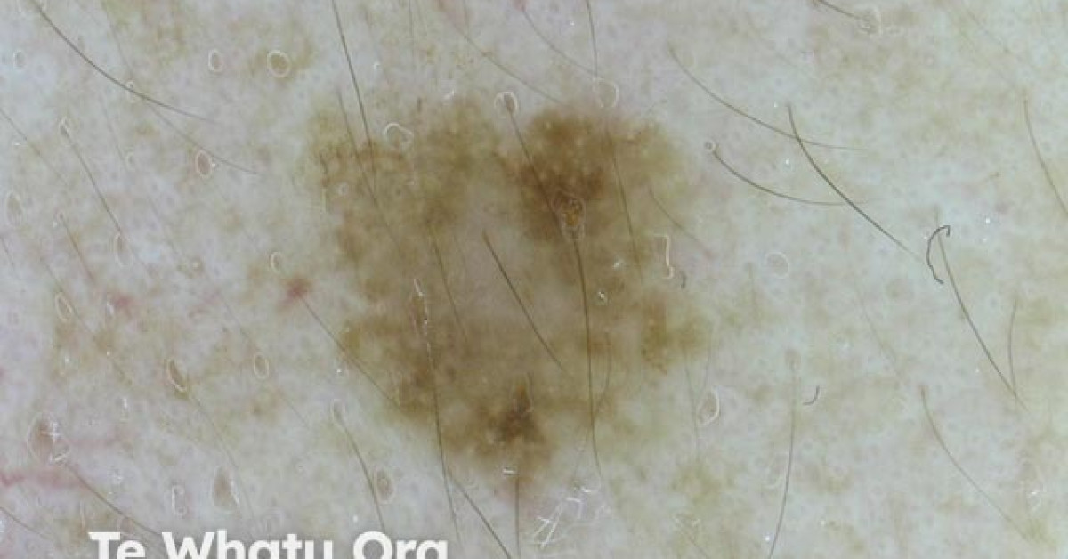 Solar lentigo dermoscopy image