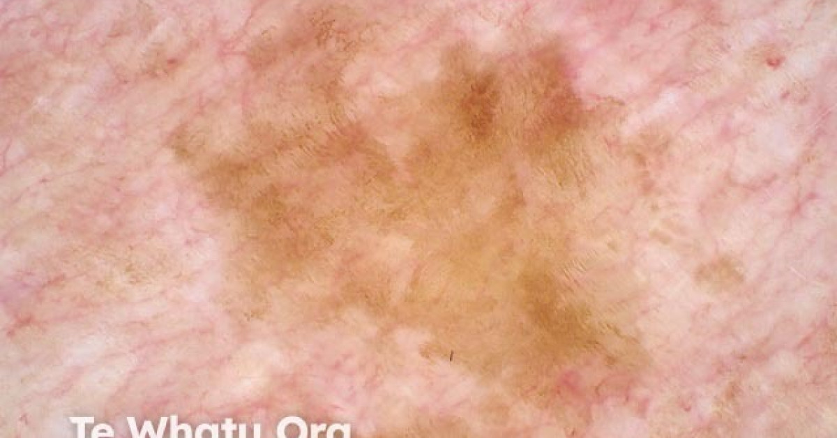 Solar lentigo dermoscopy image