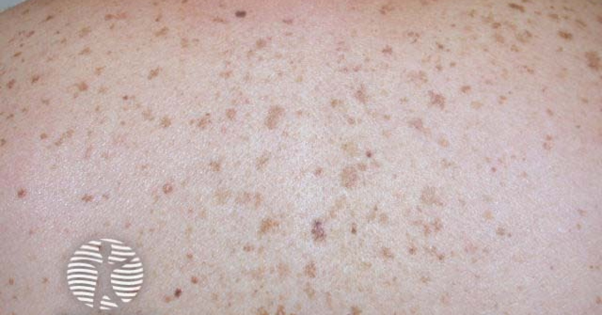 Solar lentigo dermoscopy image