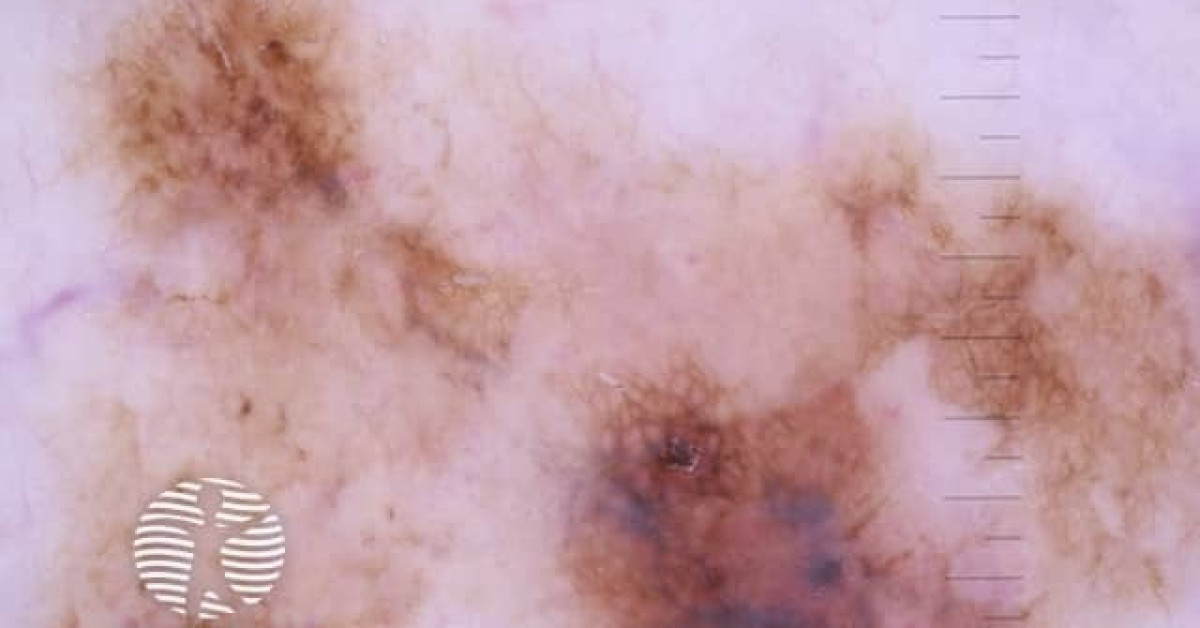 Superficial spreading melanoma dermoscopy image
