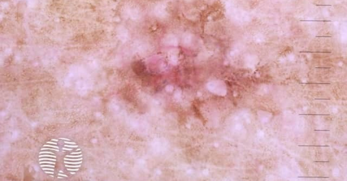 Superficial spreading melanoma dermoscopy image