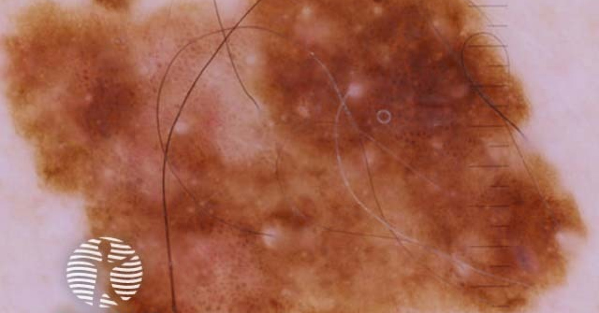 Superficial spreading melanoma, Breslow 0.3mm, polarised dermoscopy ...