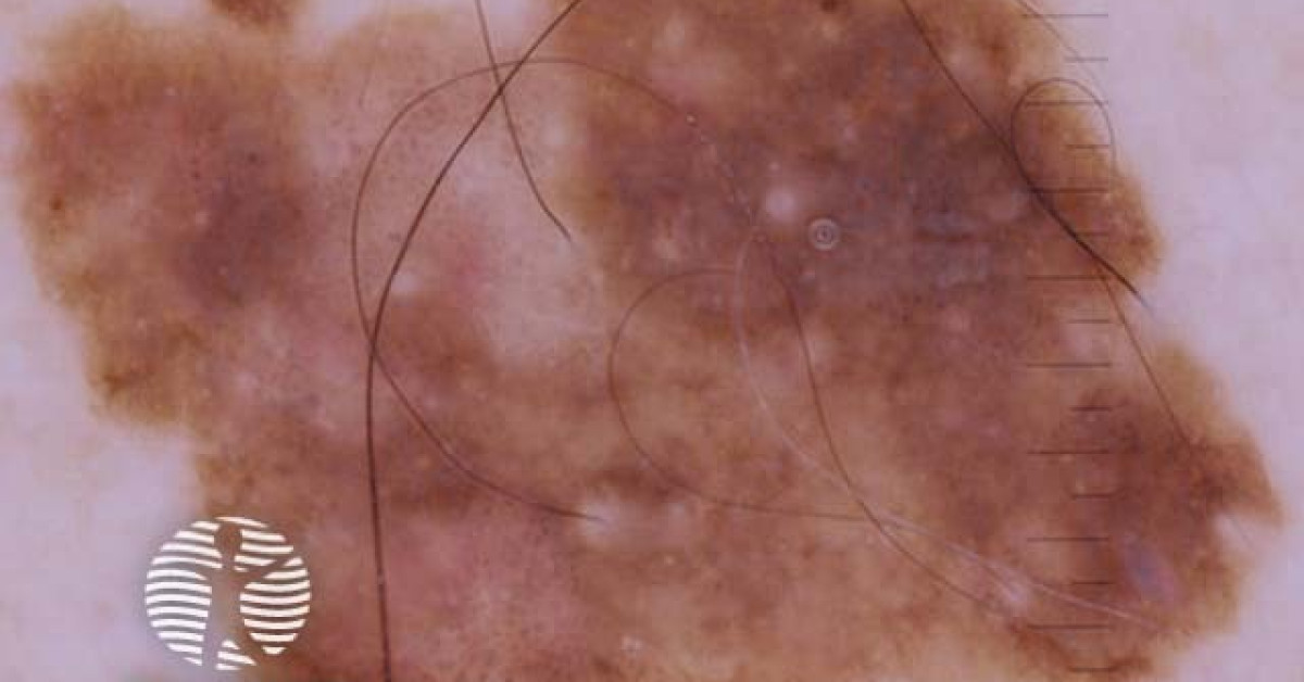 Superficial spreading melanoma, Breslow 0.3mm, nonpolarised dermoscopy ...