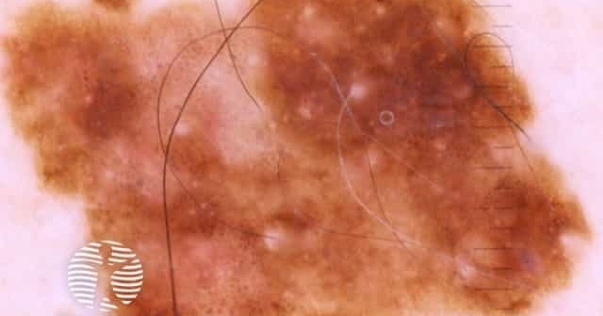 Superficial spreading melanoma, Breslow 0.3 mm image