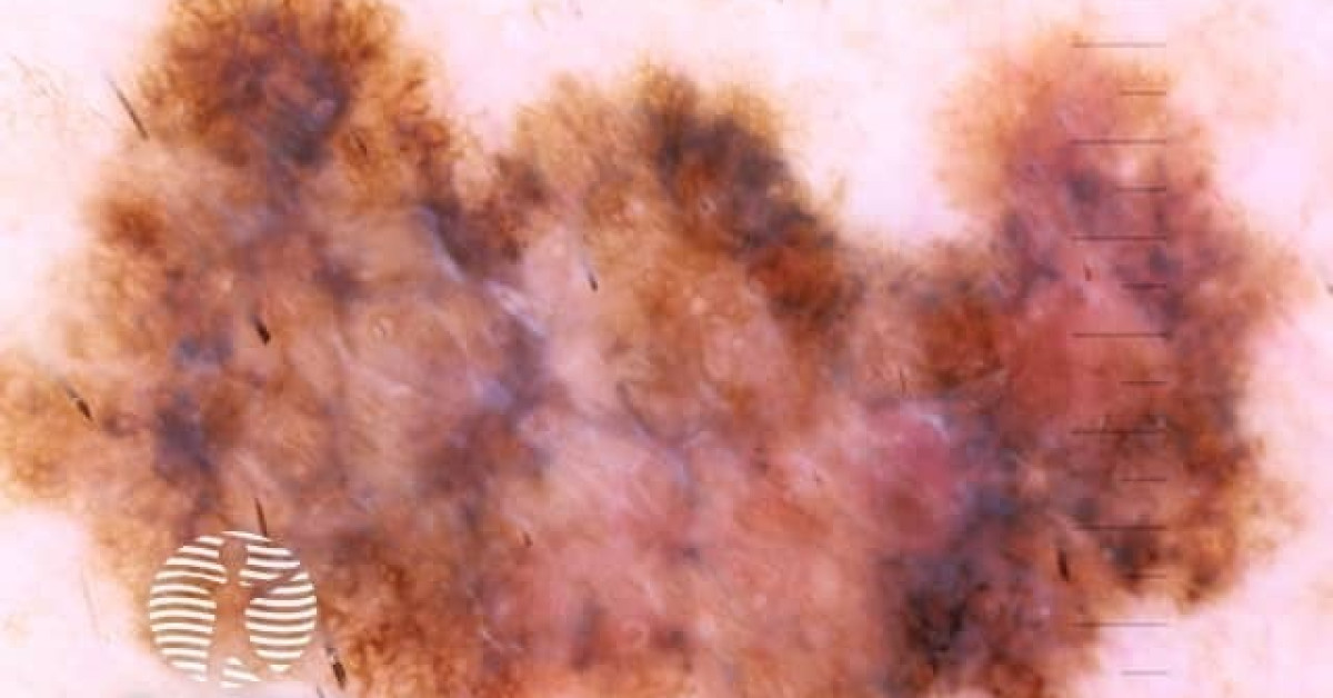 Superficial spreading melanoma dermoscopy image