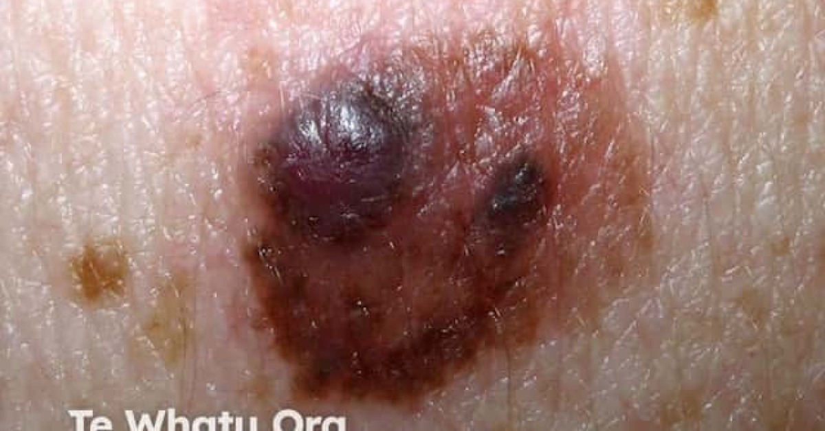 Superficial spreading melanoma image