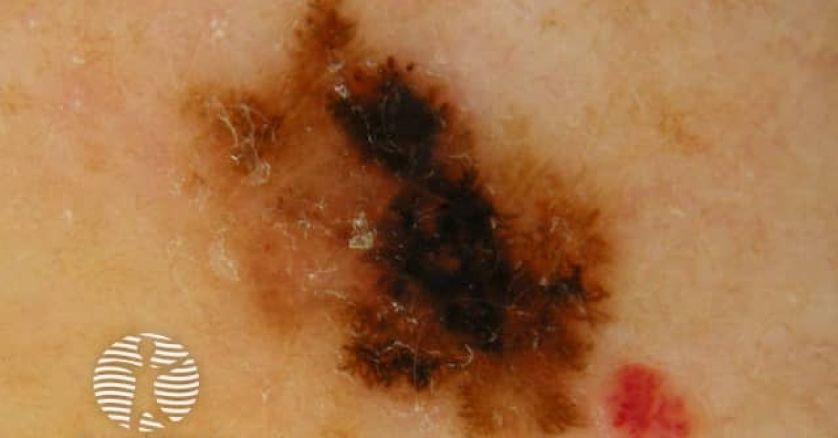 Superficial spreading melanoma dermoscopy image
