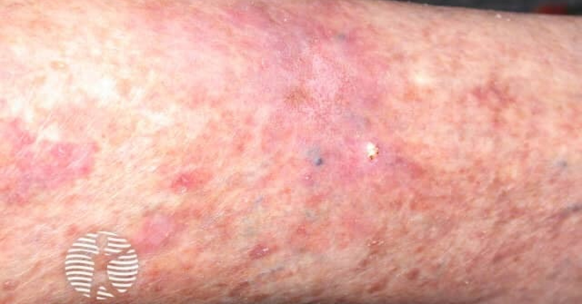 Basal Cell Cancer On Thigh at Mary Bilbo blog