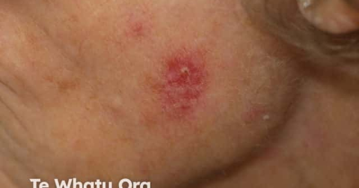 Superficial basal cell carcinoma, face image