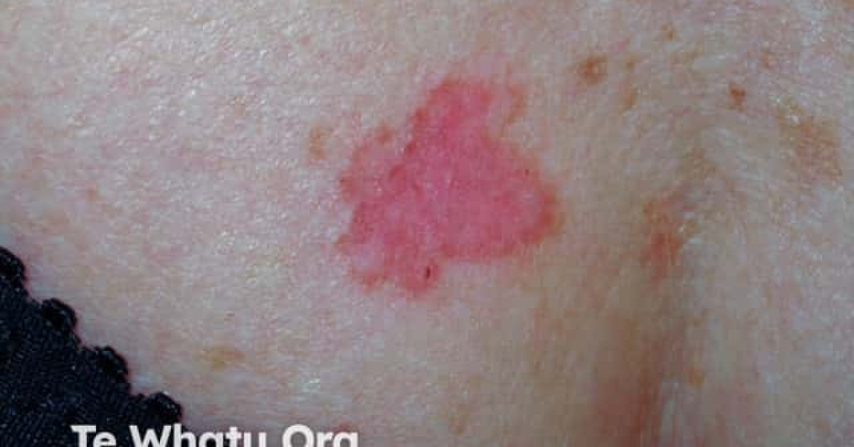 Superficial basal cell carcinoma, chest image