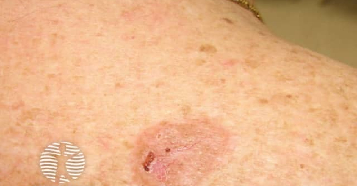 Superficial basal cell carcinoma, shoulder image
