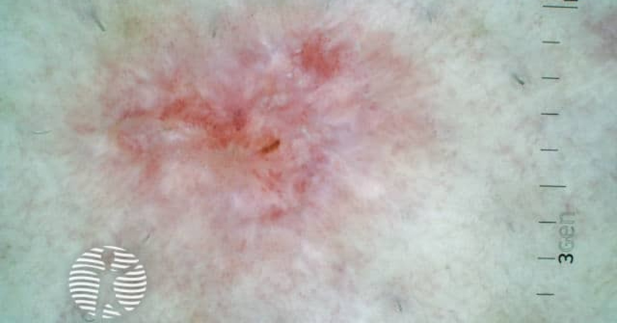 Superficial basal cell carcinoma dermoscopy image