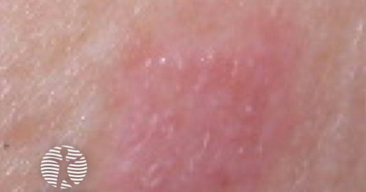 TSF resin patch image