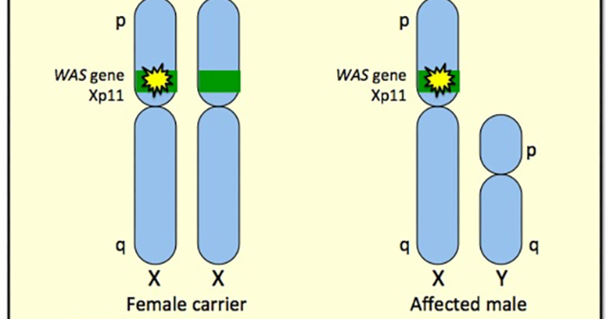 Wiskott Aldrich Syndrome image