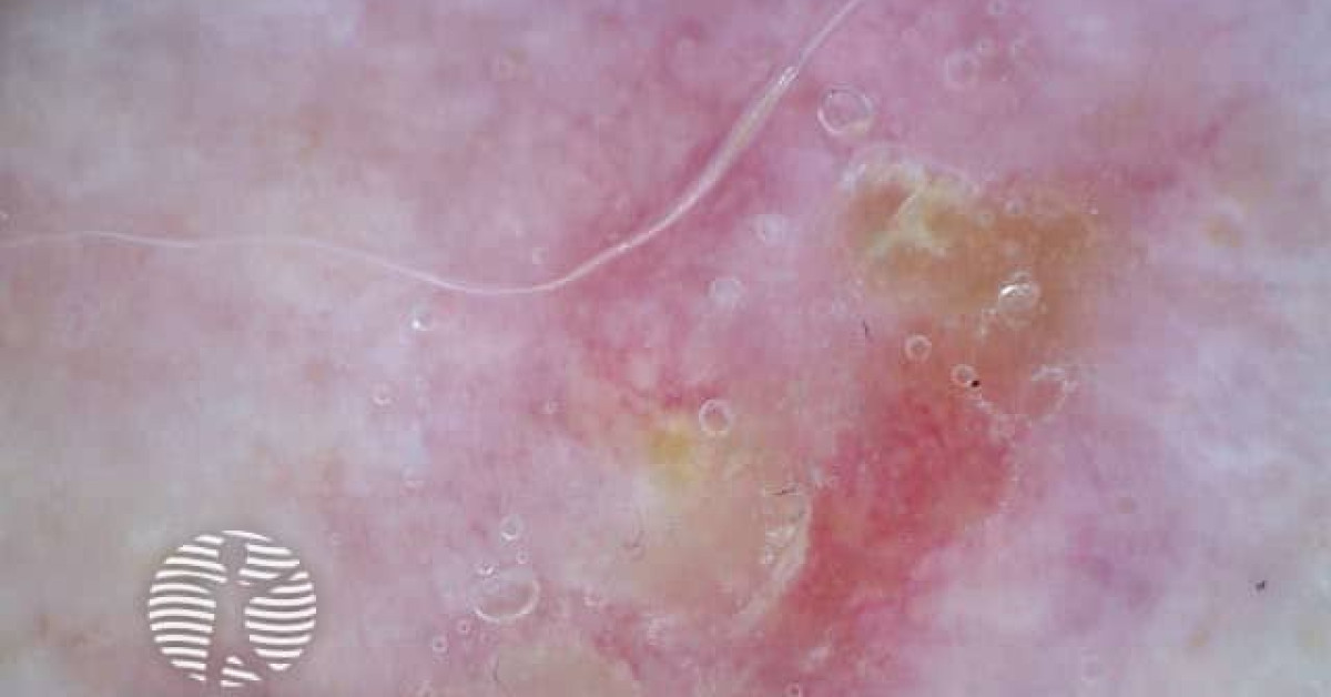 Acanthoma fissuratum — dermoscopy view image