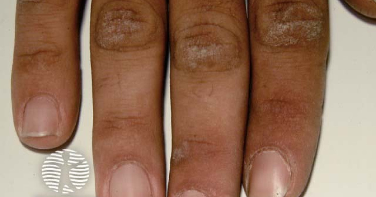 Acanthosis nigricans image