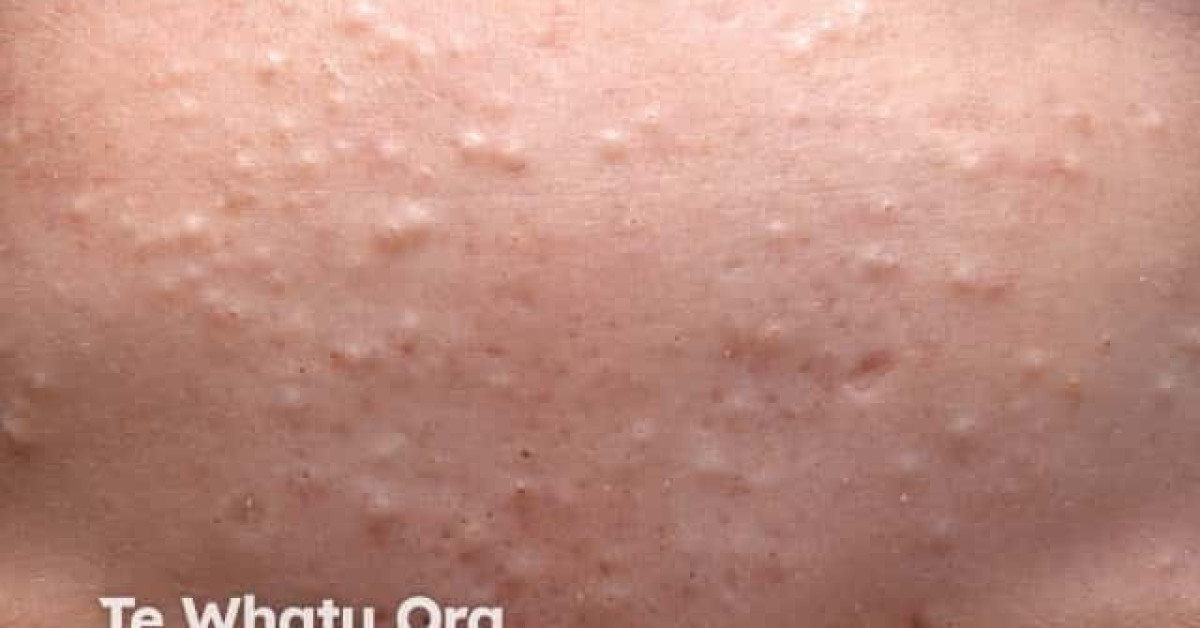 Closed comedones image