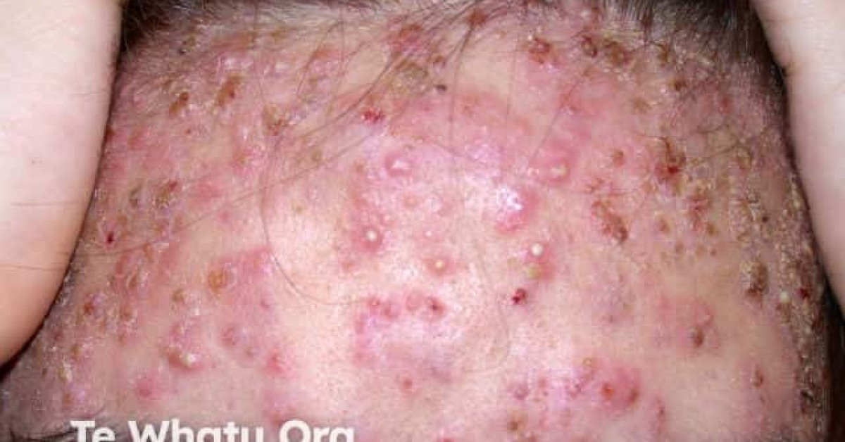 Acne fulminans image