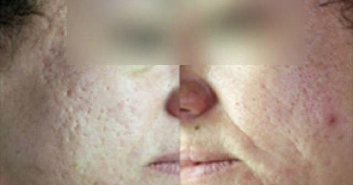 Rolling acne scars image Rolling acne scars image