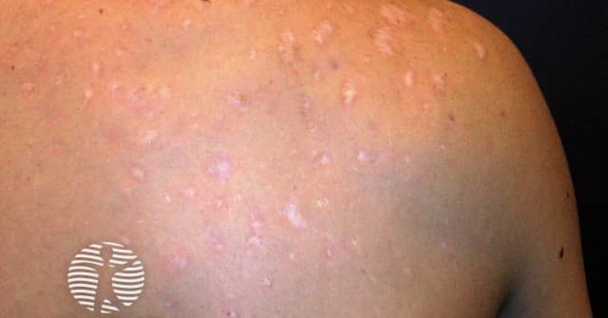 Acne affecting the back images image