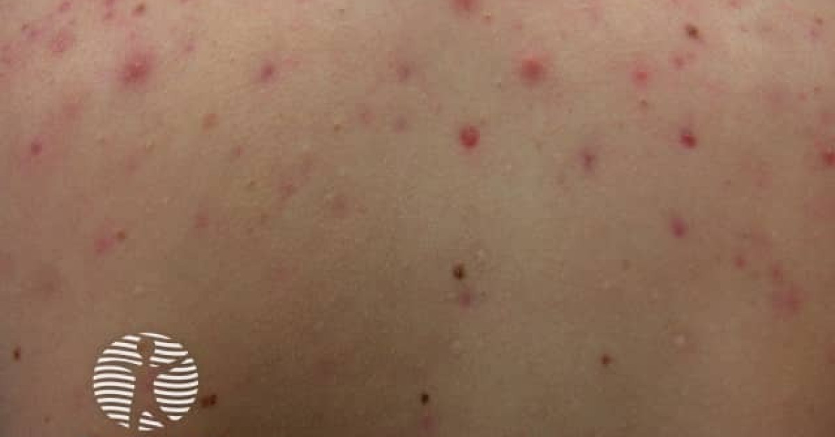 Acne affecting the back images image