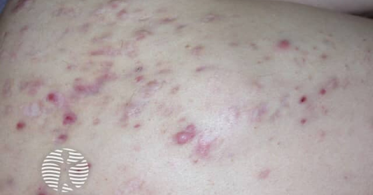 Acne affecting the back images image
