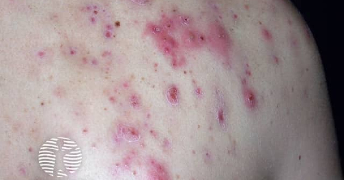 Acne affecting the back images image