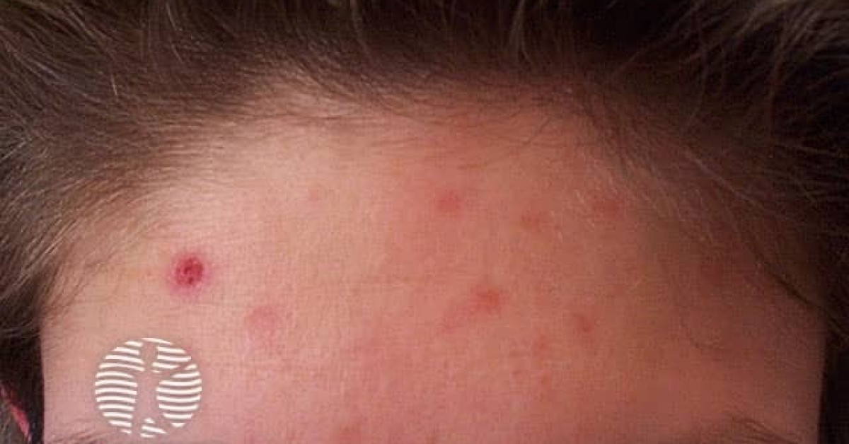 Acne excorieé image