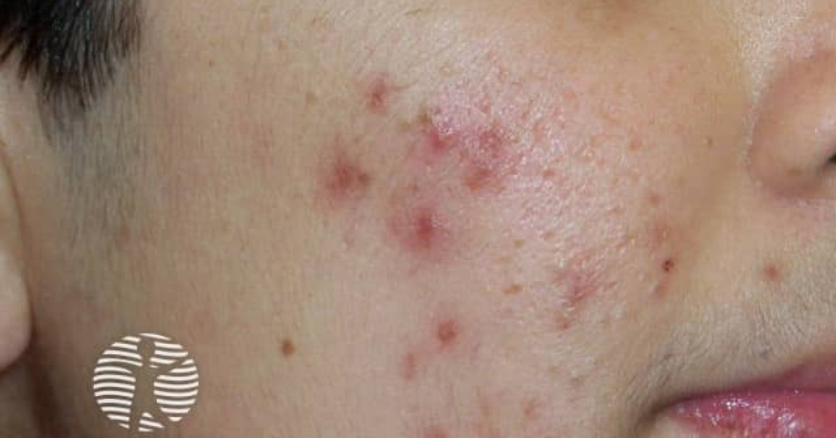 acne-face_1_10 image