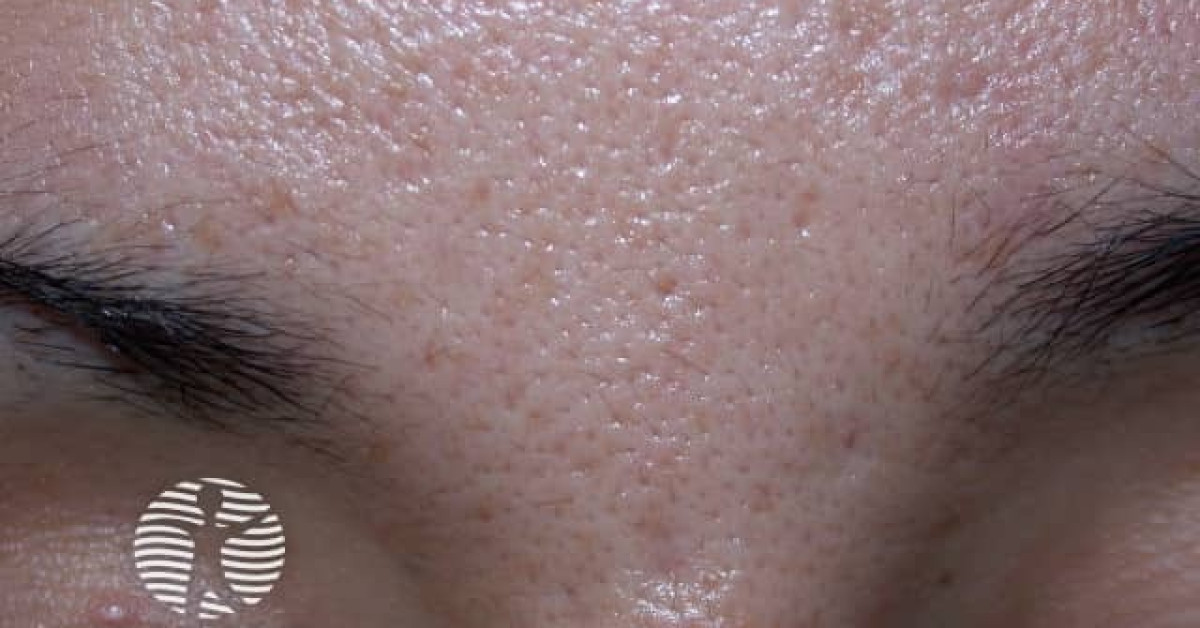 DermNet® - Facial acne image