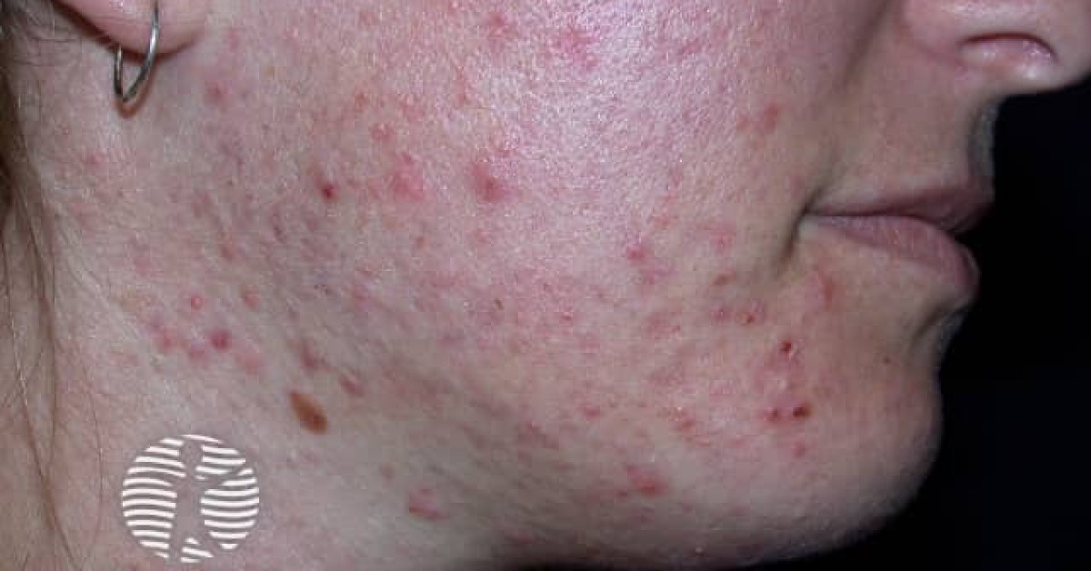 DermNet® - acne-face_1_27 image