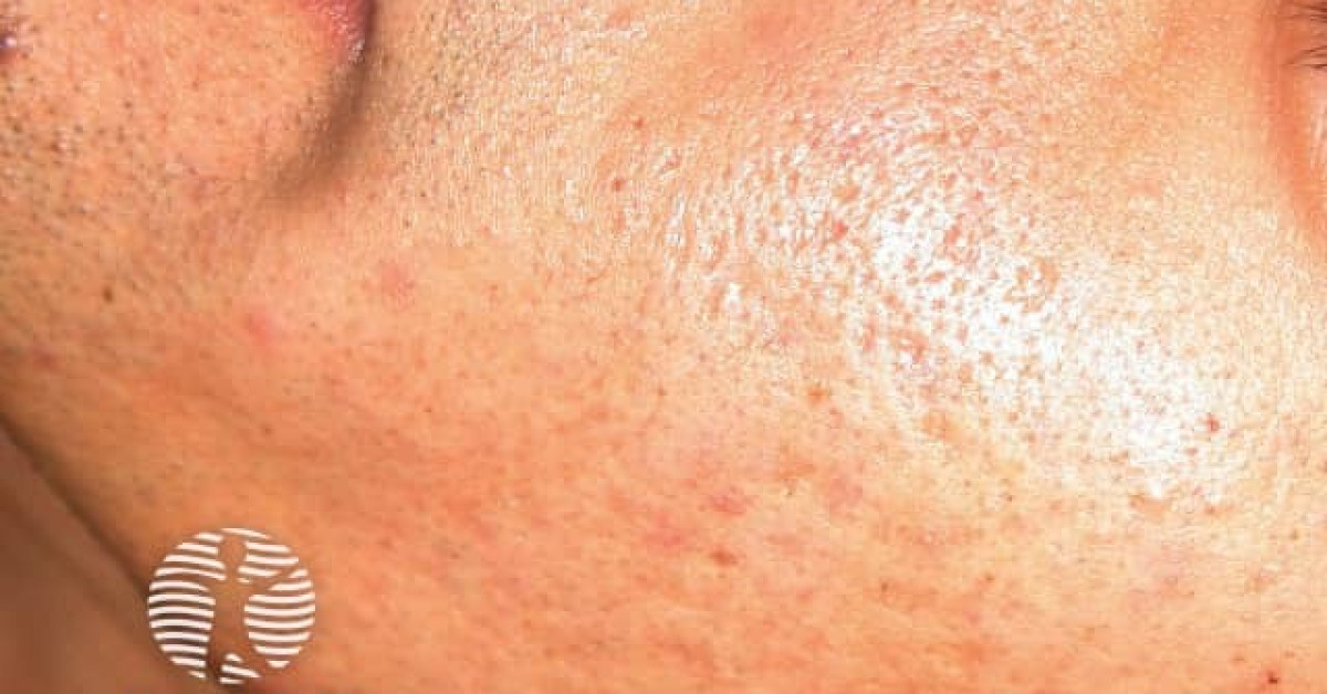 acne-face_1_34 image