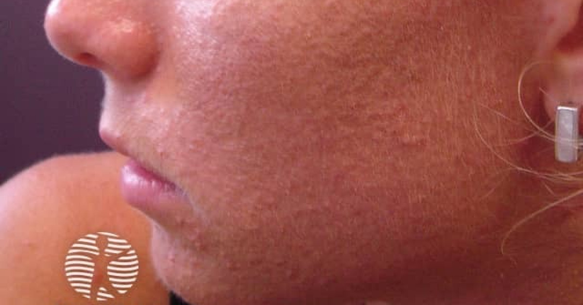 DermNet® - acne-face_1_35 image