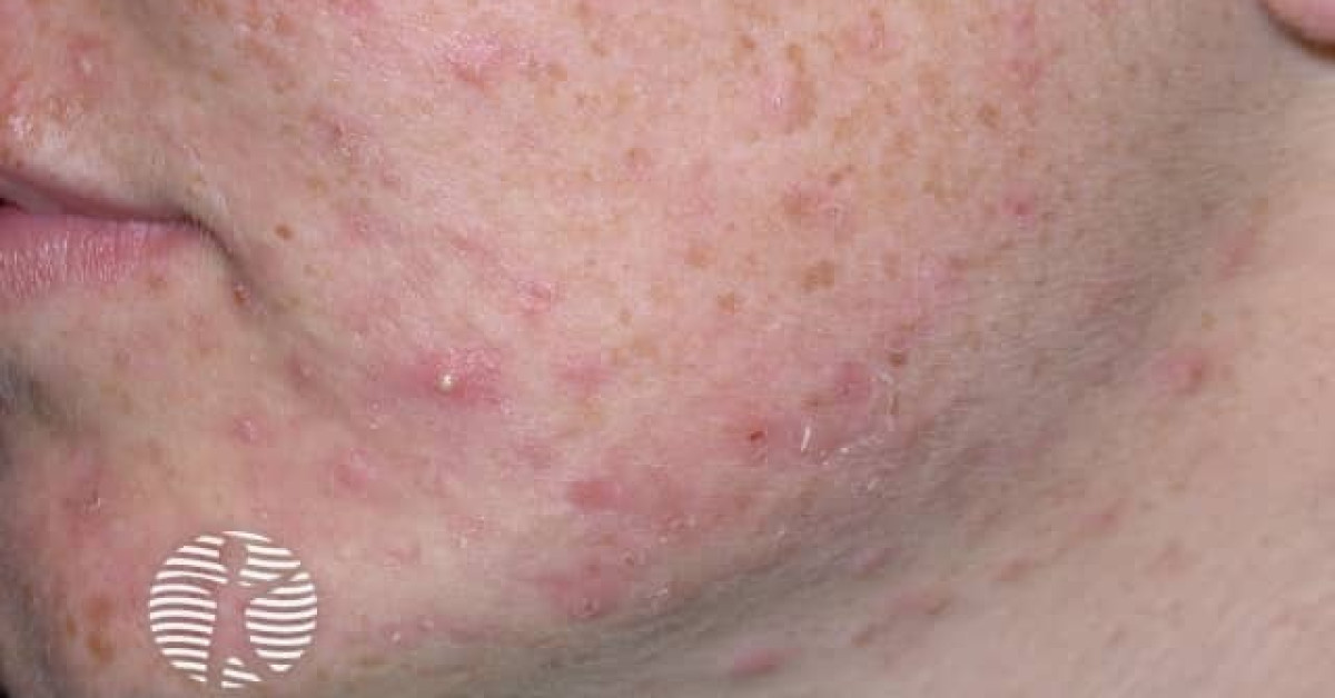 Facial acne image