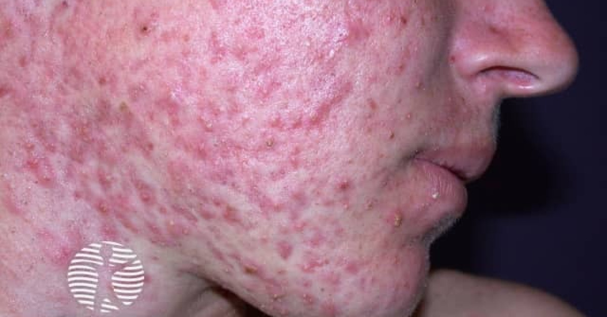 DermNet® - acne-face_15_1 image