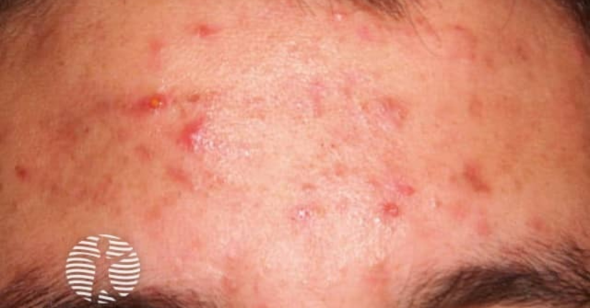 DermNet® - acne-face_19 image