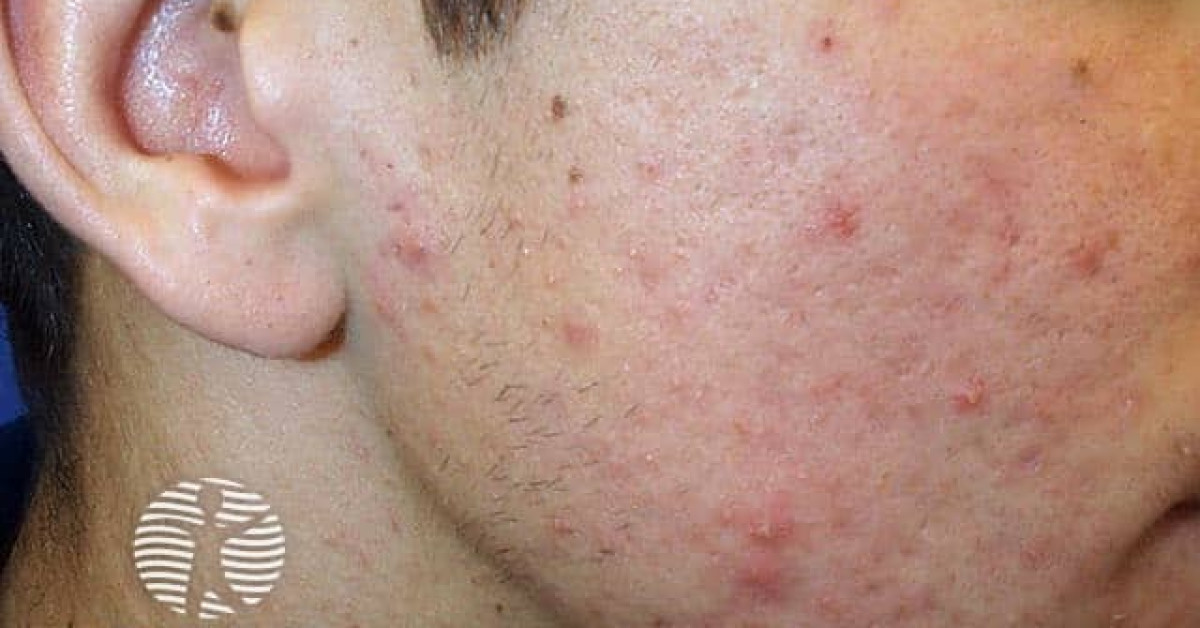 Facial acne image